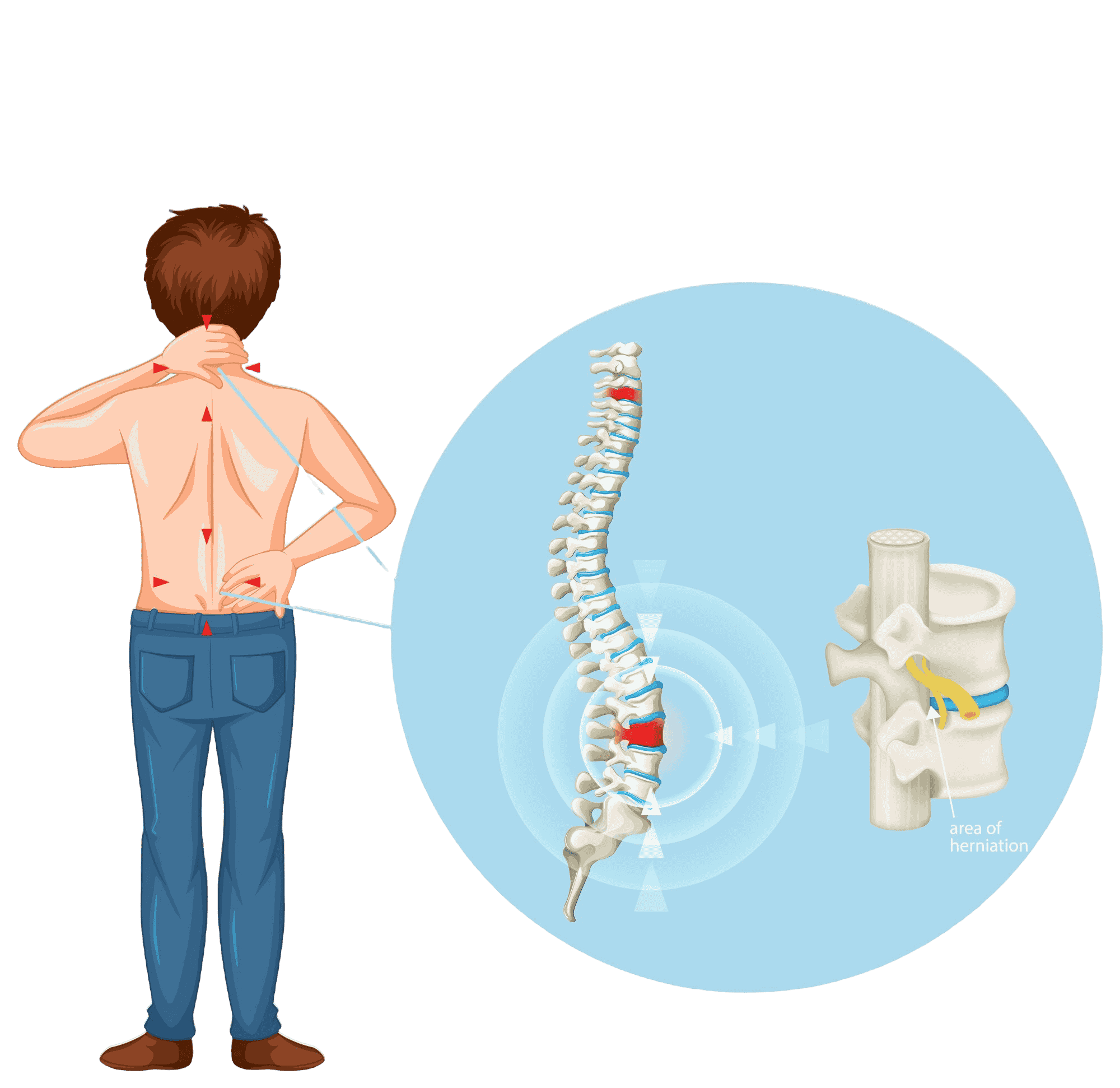Herniated Disc Hip Pain: Causes, Symptoms, and Relief - Hijama Nation
